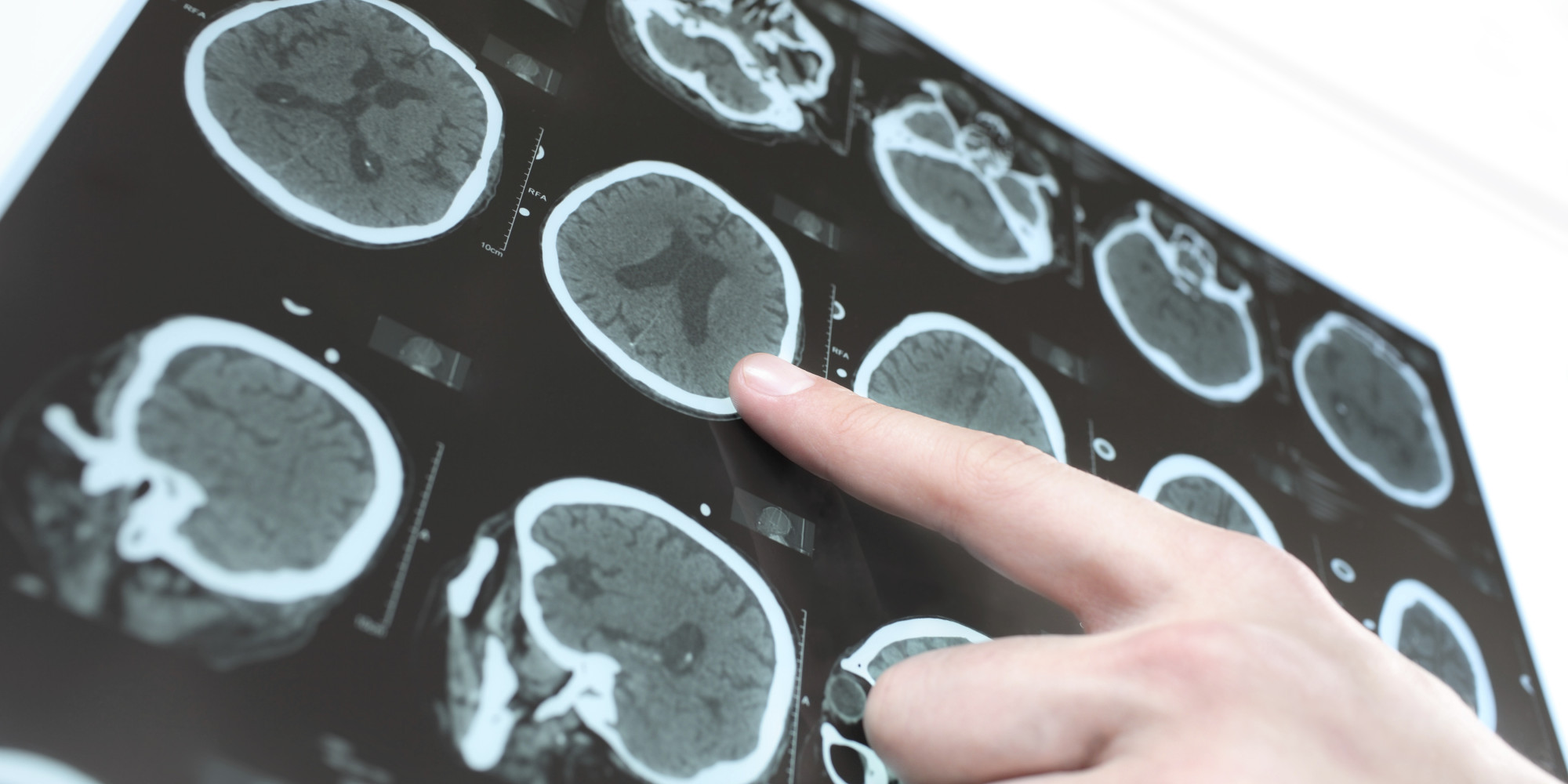 Taking Calcium Supplements Causes Brain Lesions | Wake Up World